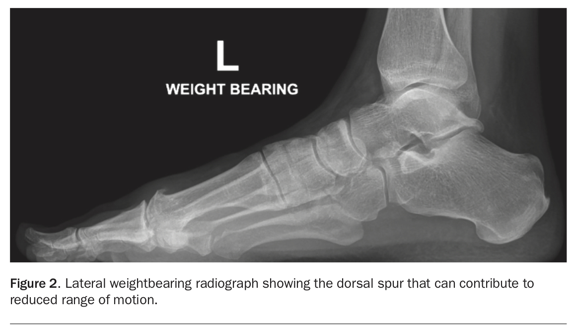 Hallux Rigidus X Ray